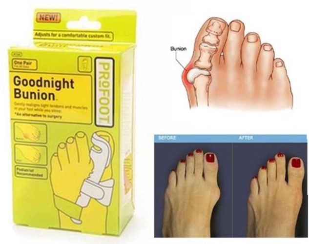 Longeta za ispravljanje čukljeva - MIKO SHOP