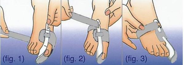 Longeta za ispravljanje čukljeva - MIKO SHOP